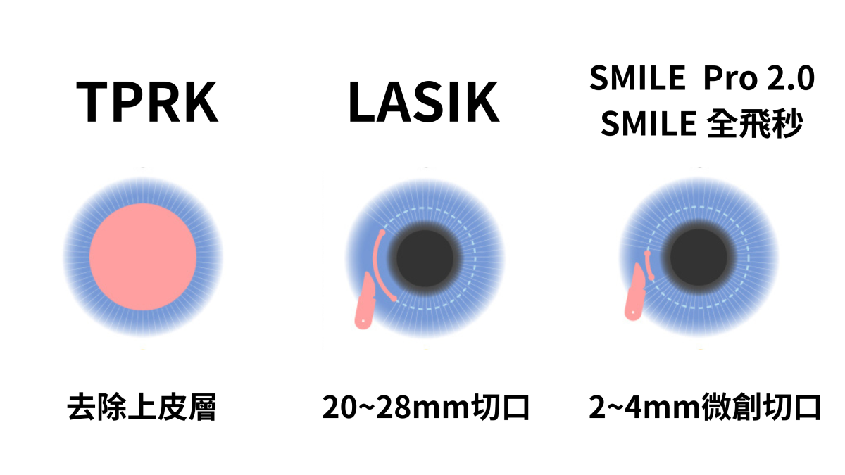 SMILE PRO 2.0、SMILE、LASIK 和 TransPRK：該如何選擇適合的近視雷射手術？ - 白佳欣眼科